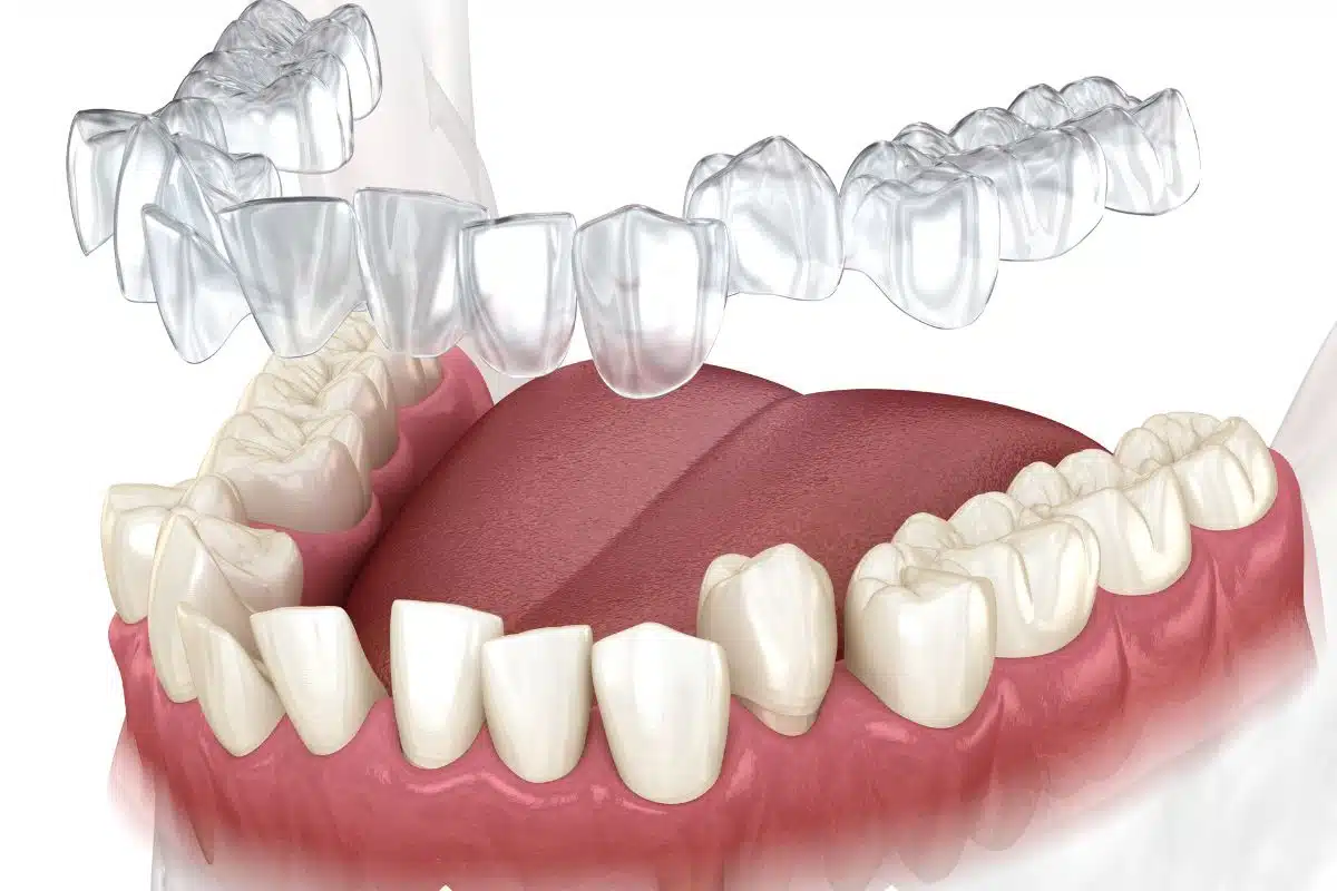 Can Invisalign Fix Crowded Teeth Without Extraction?
